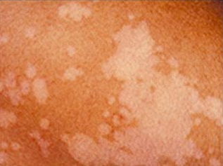 Cara Menghilangkan Panu Dengan Cepat