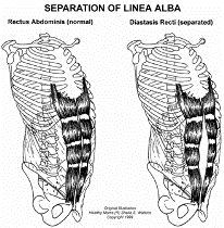 Línea Alba o Diástasis Abdominal ~ Nioz