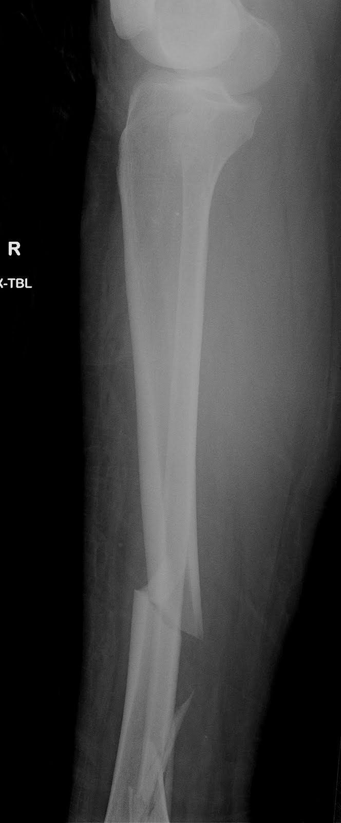 Complex Tibia Fracture ~ Orthopaedi