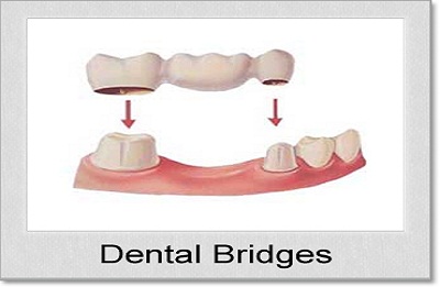 tooth root canal: Dental Bridges