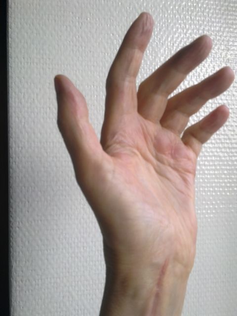 Handrehabilitationcase with Dupuytren's contracture.: A trauma in the ...