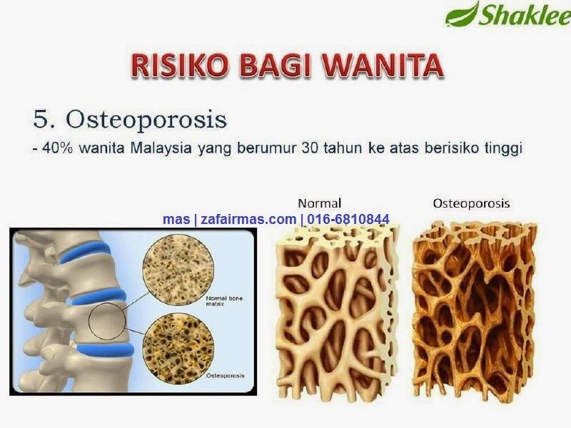 ZaFairMAS: Penyakit Radang Sendi : Arthritis