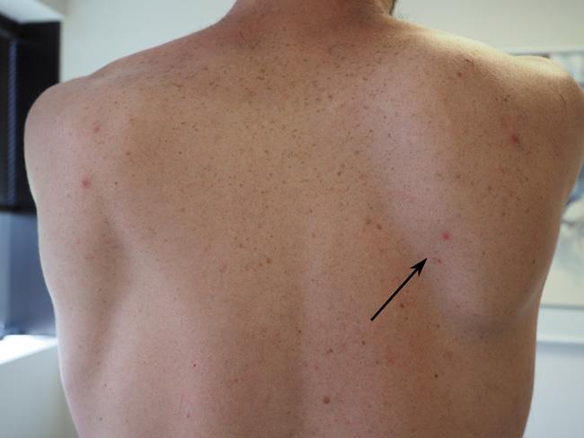 Combat a protracted scapula with these two specific shoulder exercises!