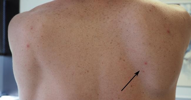 Combat a protracted scapula with these two specific shoulder exercises!