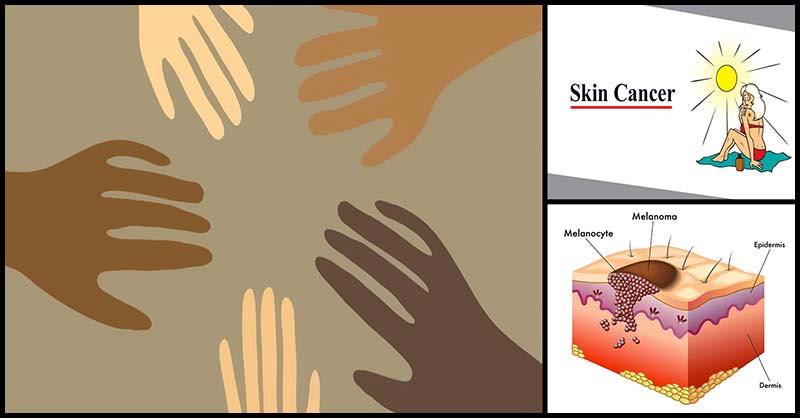 Effective Natural Extracts That Can Treat Or Prevent Skin Cancer | Dr ...