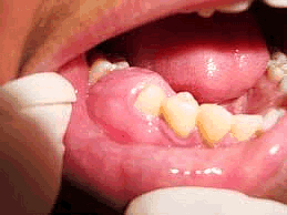 Clinica Dentaria Mais Sorriso: Sintomas e tratamento de abscessos ...