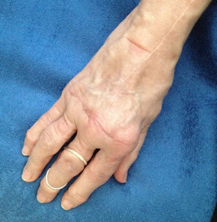 Here's Your Gold Watch - Rheutired: Arthroplasty of the MCP Joints (New ...
