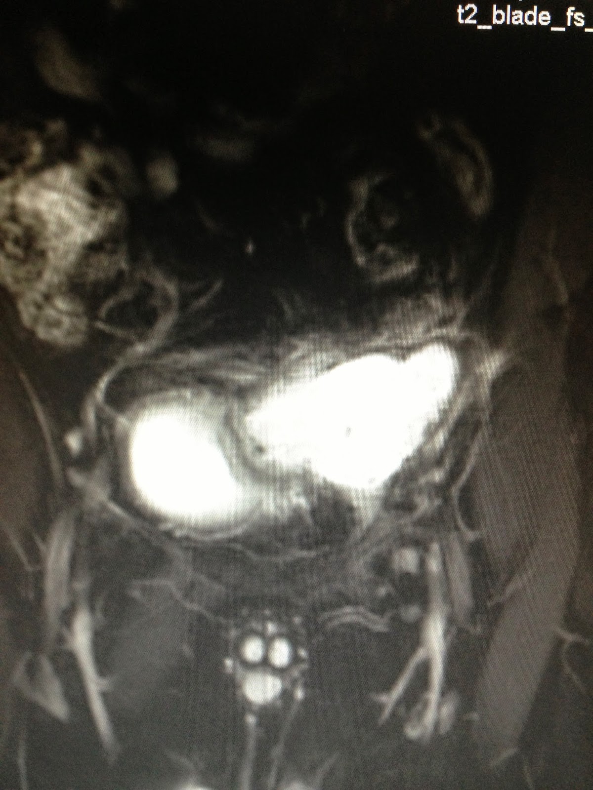 VIETNAMESE MEDIC ULTRASOUND: CASE 282: SUPRAPUBIC MASS, Dr PHAN THANH ...