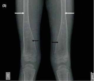 Spot diagnosis? Identify the deformity? Erlenmeyer flask deformity