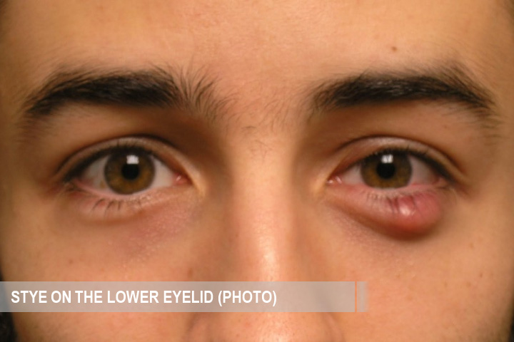 Eye Stye: What you need to know. Basic information. Wiki
