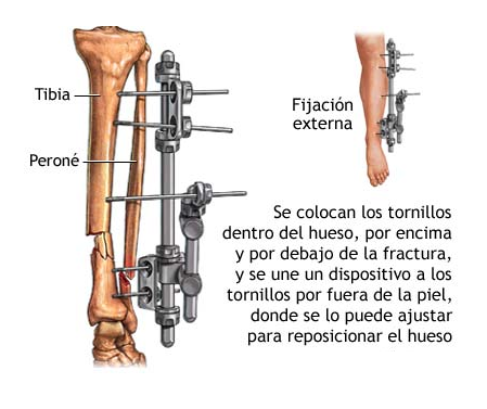11:50: ¿Qué es osteotaxis?