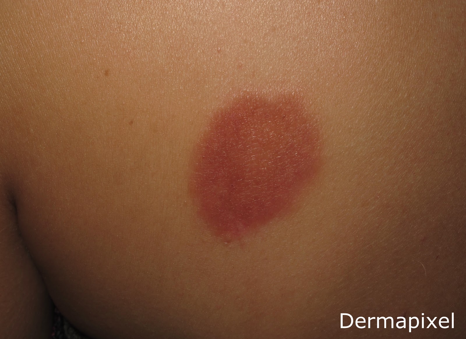 Dermapixel: noviembre 2017