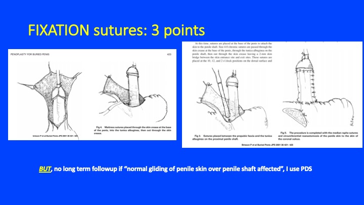 Kuching Urology古晉秘尿專科: Buried Penis, Malaysian Urological Conference ...