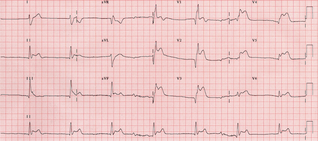 12 Lead EKG: A Broken Heart Mirrors Signs Of A Heart Attack Doctors ...