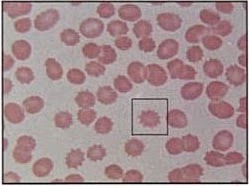 Células importantes en hematología: ACANTOCITOS