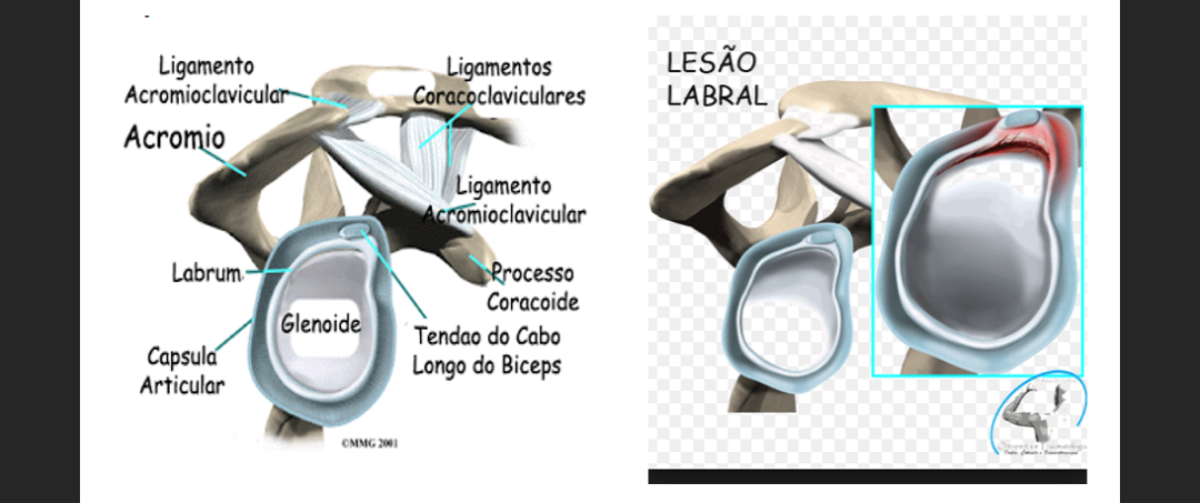 Exames Contrastados : Artrografia