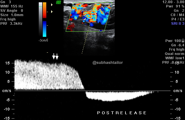 SONO DIGEST: TESTICULAR DOPPLER ; VARICOCELES - COLOR & SPECTRAL DOPPLER