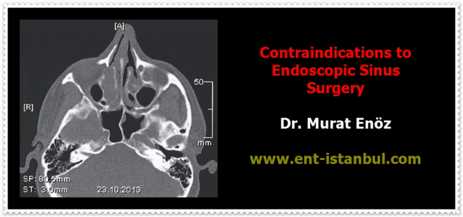 Endoscopic Sinus Surgery