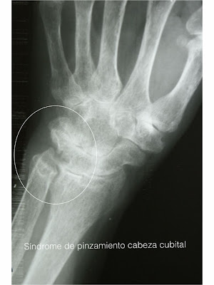 OSSA CARPALIA ©: La articulación radio cubital distal en la artritis ...