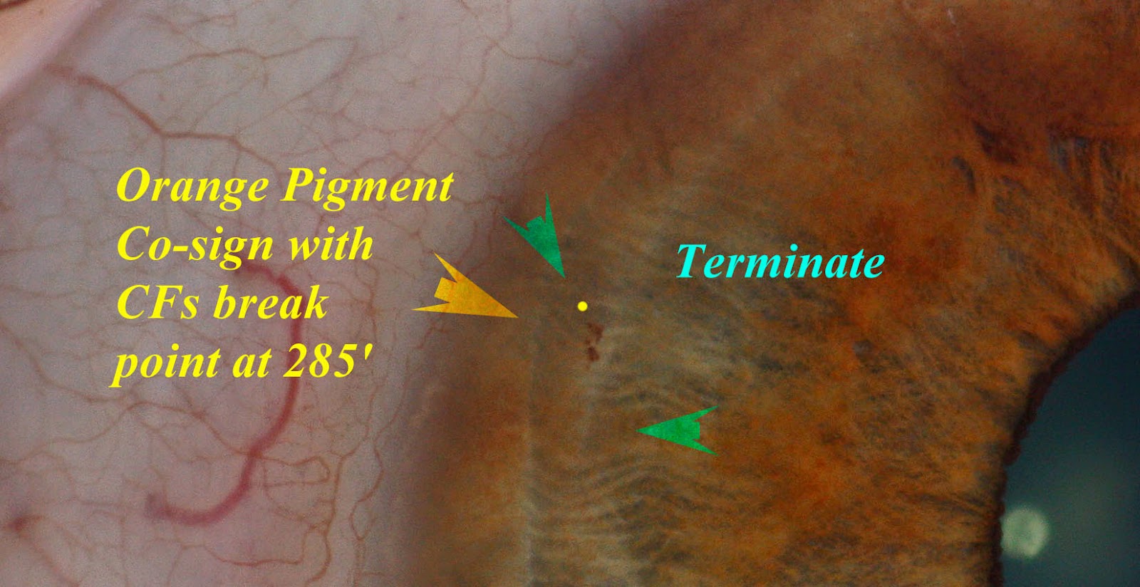 Modern & Multidimensional Iridology: Orange Pigment Co-Sign with ...