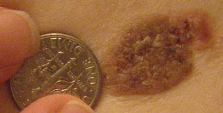 Chemical Peels for Acne and Anti Aging: Large Mole Removal with TCA ...