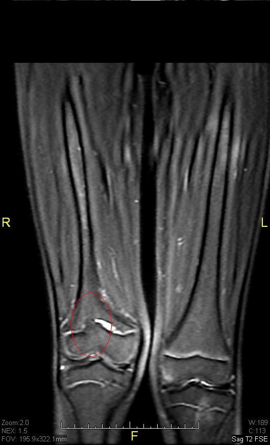 Physeal bar-Plain film & MRI - Sumer's Radiology Blog