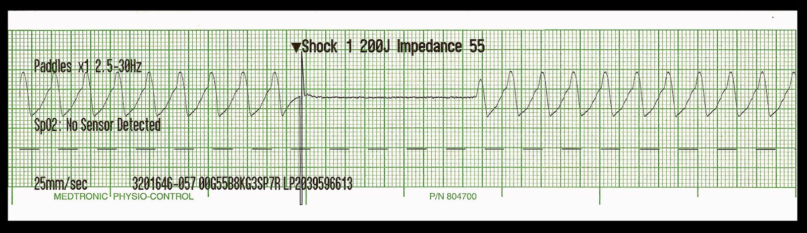 EKG Rhythm Quiz 262