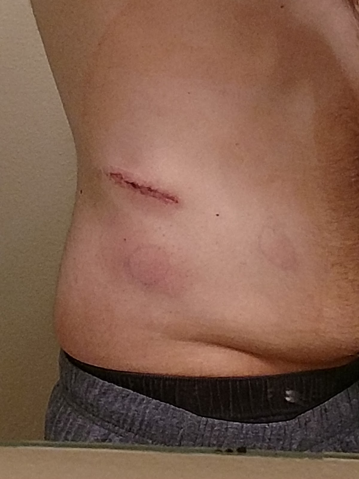 15Ten - I Am What I Am ... and more: 2 Days Later / A Surgical Update