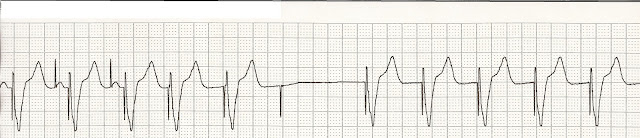 EKG Rhythm Strip Quiz 56: Paced Rhythms