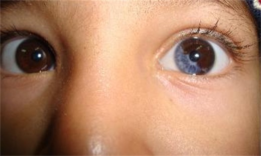 Medbizarre: Heterochromia Iridium