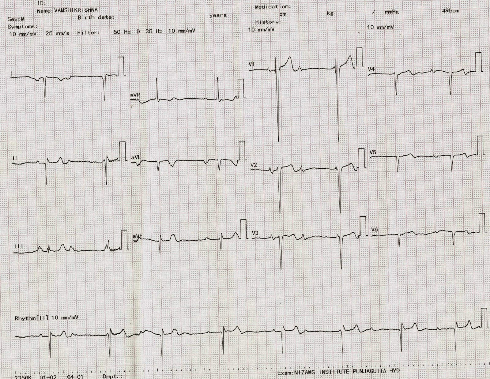 HealthforHeart: Situs inversus dextrocardia associated corrected ...