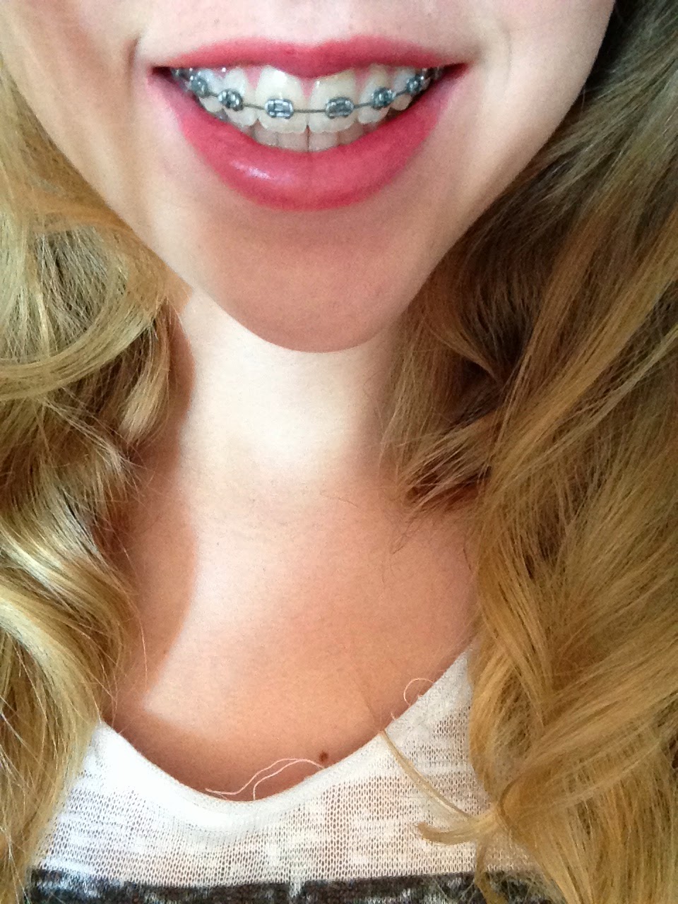 eenmeidenlevenx: Mijn beugel ervaring #1