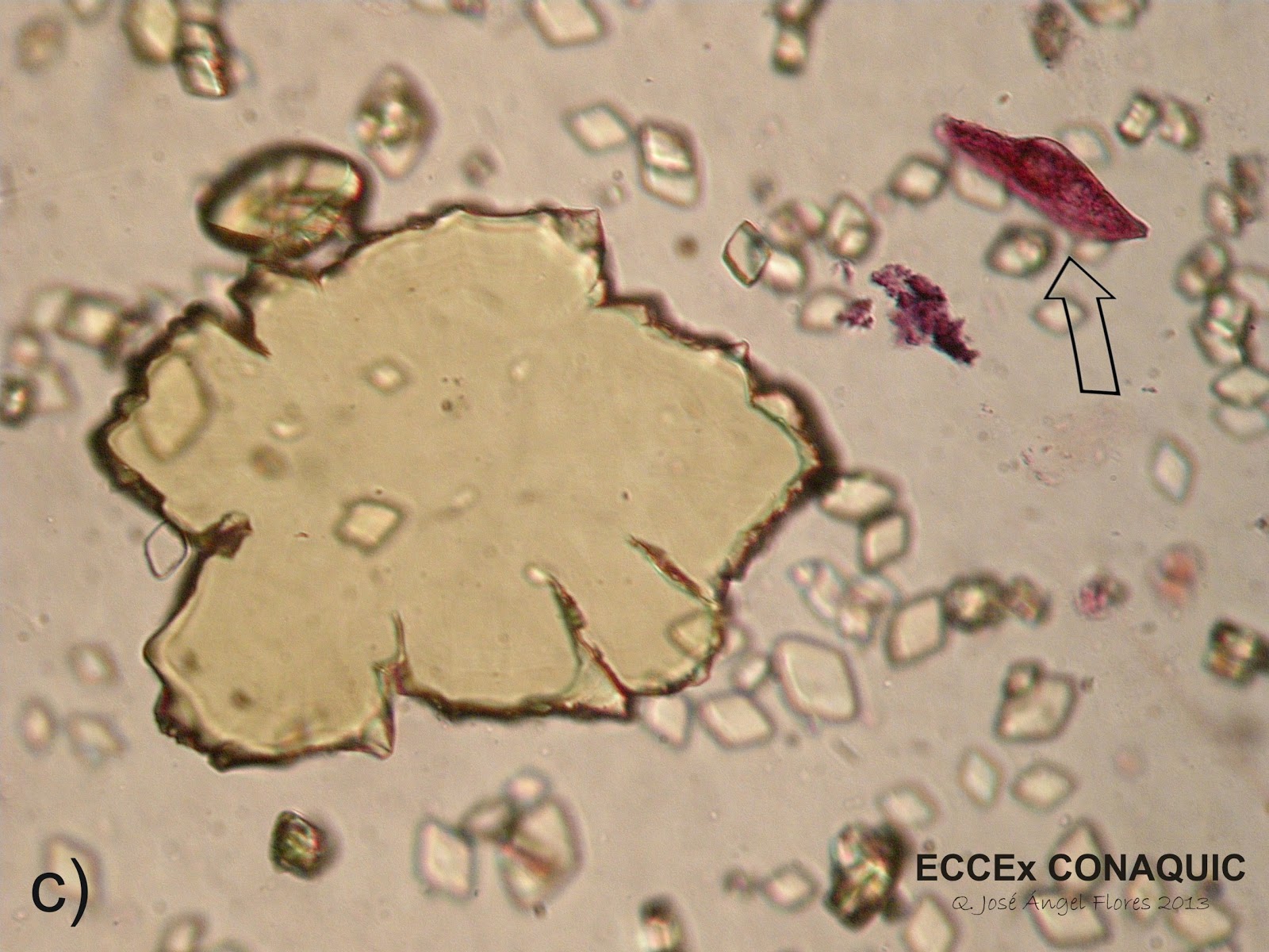 Examen General de Orina: Caso UR- marzo-13 (Enfoque: cristaluria)