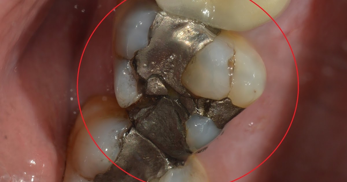 A BLOG ABOUT LIFE AND DENTISTRY: Cracked Amalgam Fillings