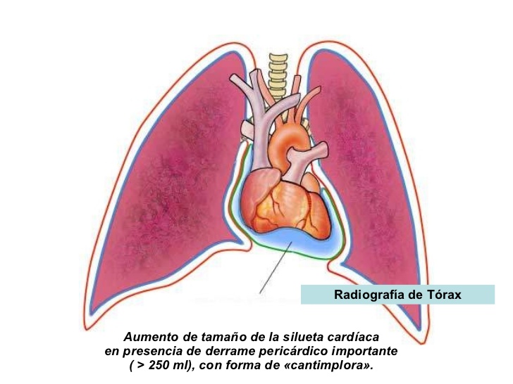 Enfermedades Pericárdicas (Patología Sistémica)