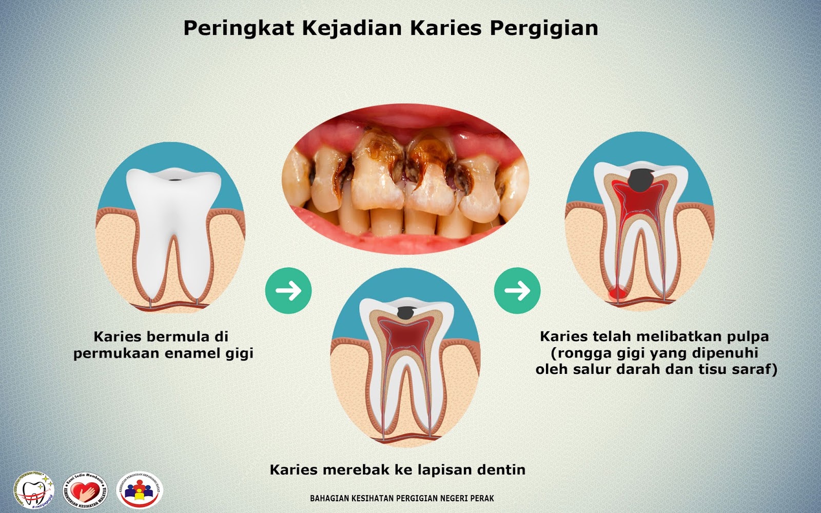 Blog Rasmi Bahagian Kesihatan Pergigian Perak: Peringkat Kejadian ...
