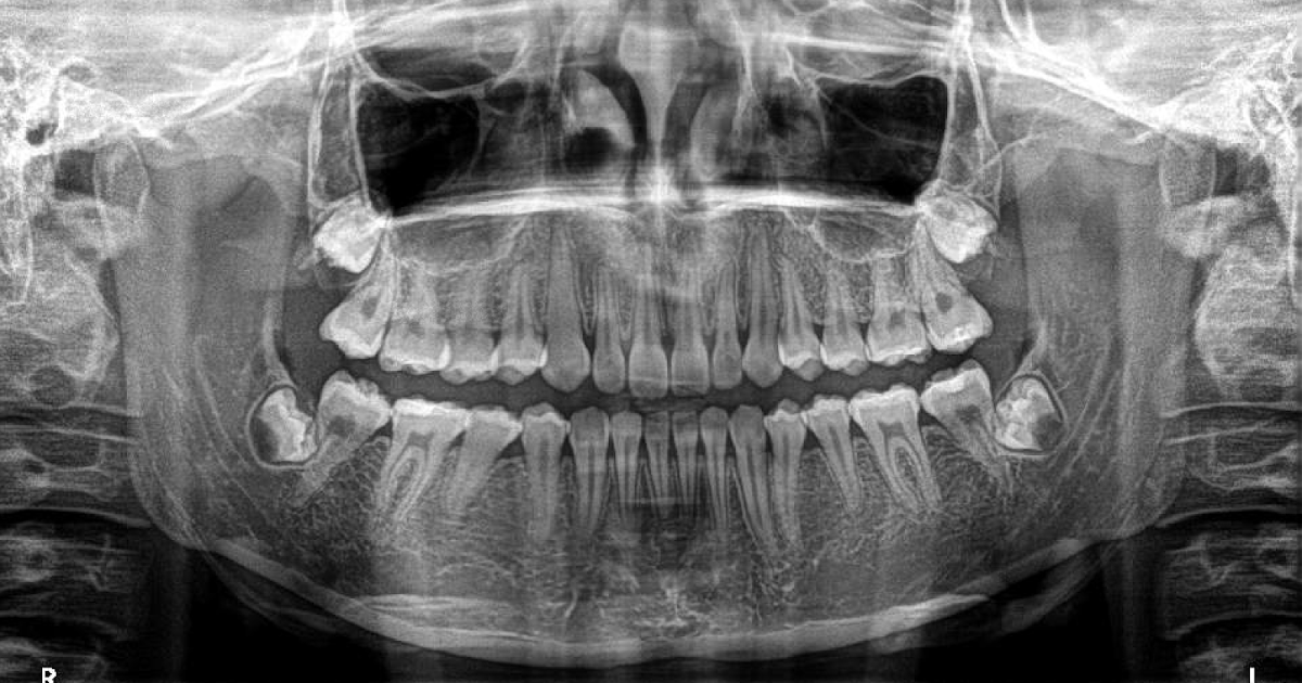 Dr Mogre Oral Facial Surgery Blog: "Impacted Wisdom Teeth": What is the ...