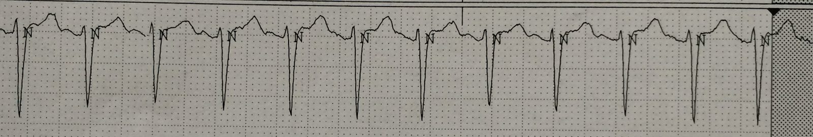 Dr. Smith's ECG Blog: Atrial fibrillation with RVR: use POCUS to assess ...