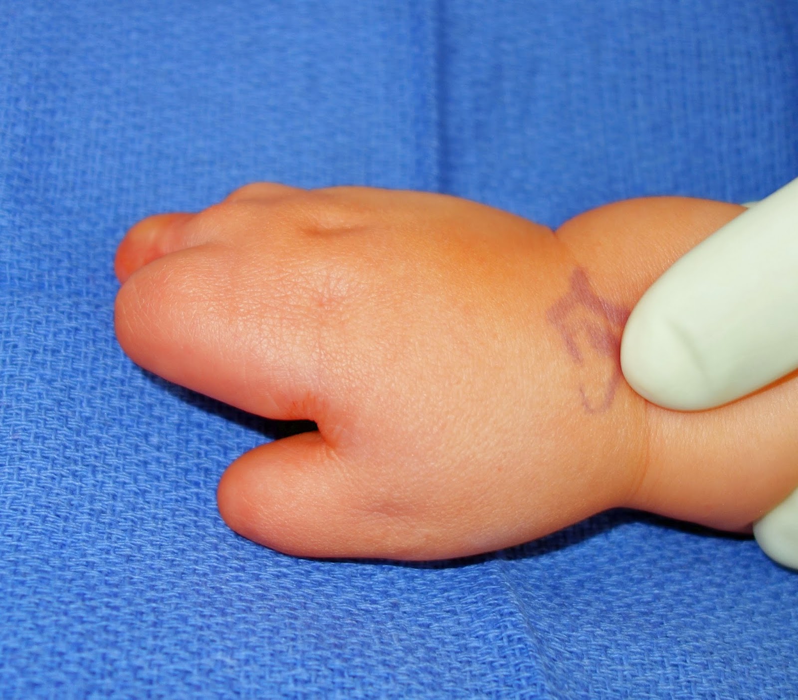 Amniotic Constriction Band Congenital Hand And Arm Differences Amniotic Constriction Band Congenital Hand And Arm Differences