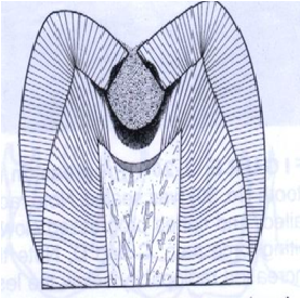Dentistry and Medicine: Dental Caries definition, Classification of ...