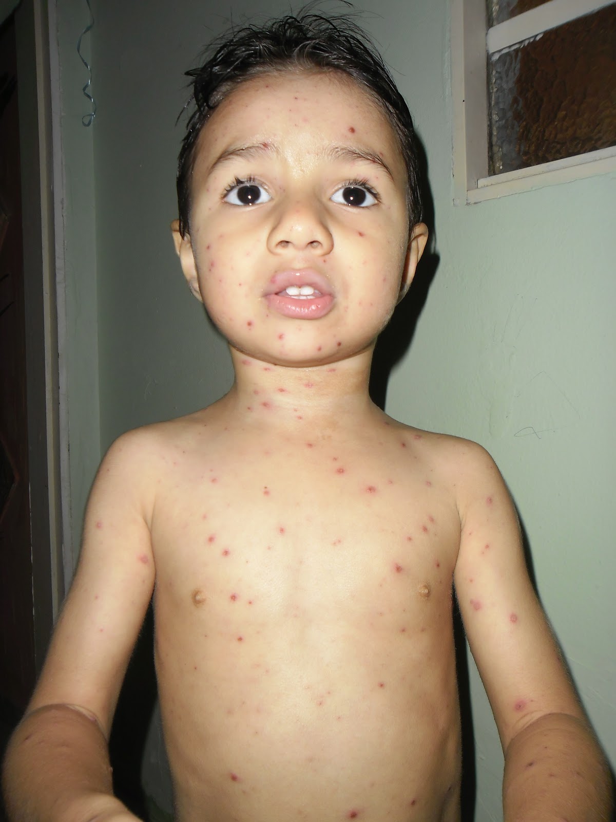 Jeitinho Mãe! : Cuidados com a varicela (ou catapora) em crianças.