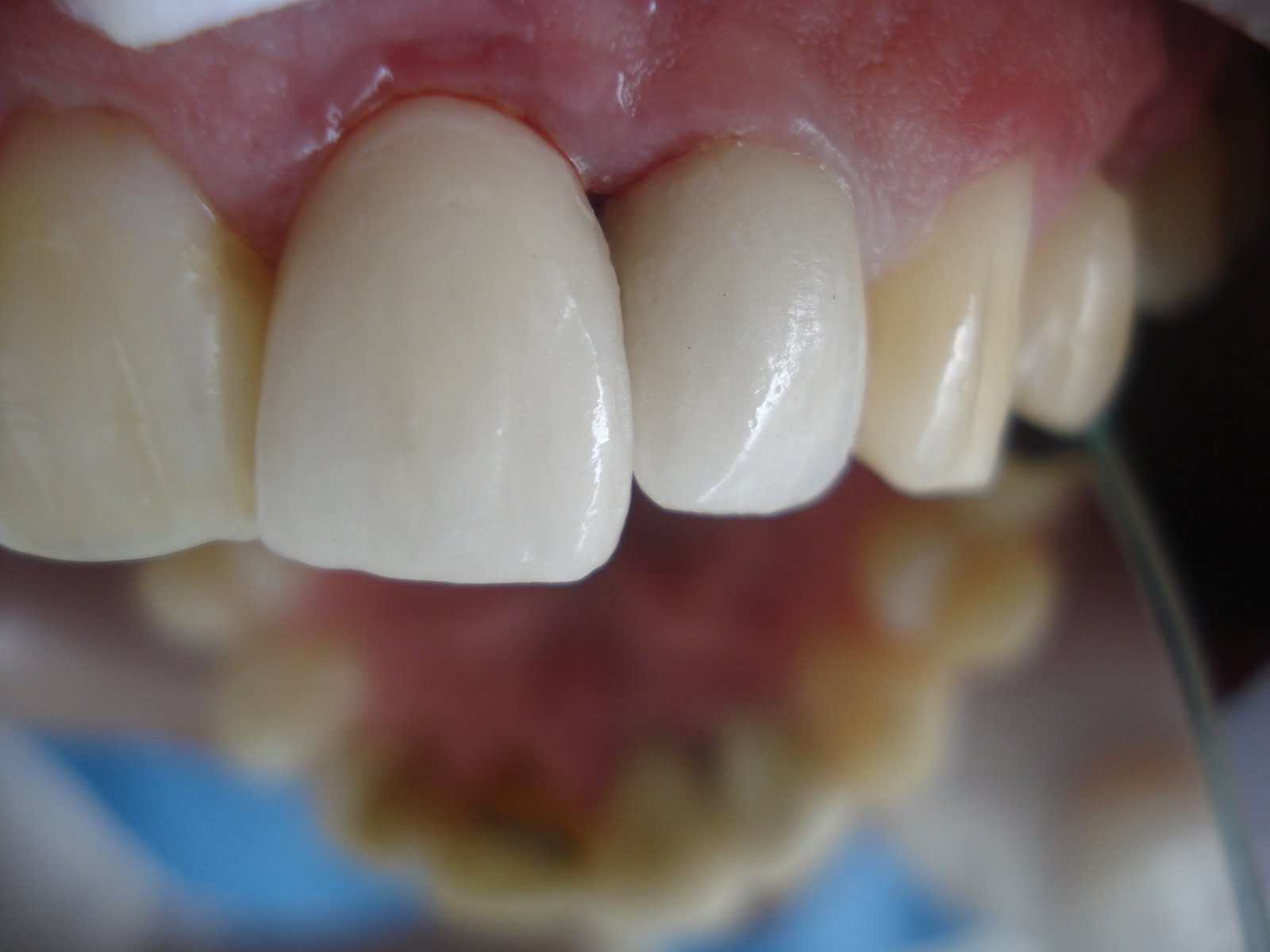 Odontología hoy: IMPLANTE UNICO EN 21 - CORONA ZIRCONIO