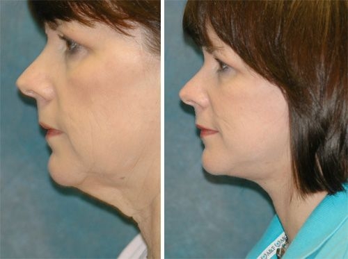 Sharpen A Flabby Jawline And Use Double Chin Exercises To Lose A Dual ...