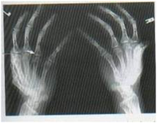 TEKNIK RADIOGRAFI OSSA MANUS ~ Radiologi