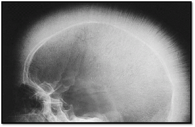 RADIOLOGY IMAGE SPOTTERS: Thalassemia