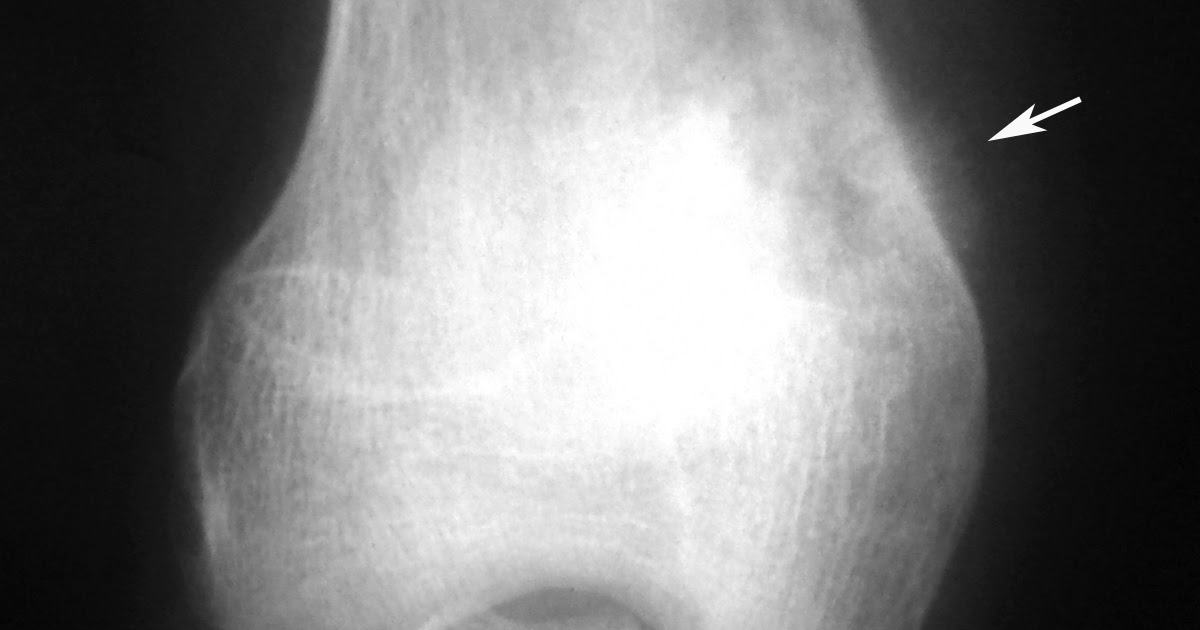 Radiodiagnosis Imaging Is Amazing Interesting Cases Osteosarcoma Of