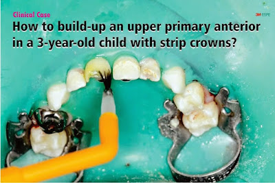 PEDIATRIC DENTISTRY: How to build-up an upper primary anterior in a 3 ...