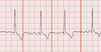 Float Nurse: EKG Rhythm Strips 56: Atrial Fibrillation