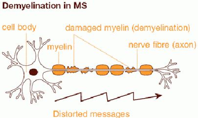 Demyelination Of Neuron |Genetic Engineering Info
