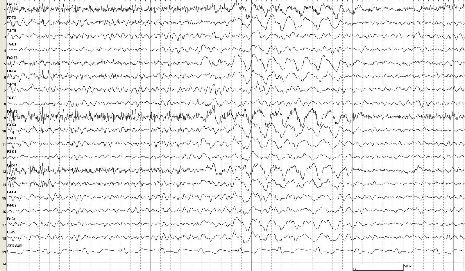 EEG Reviewer: EEG No. 11